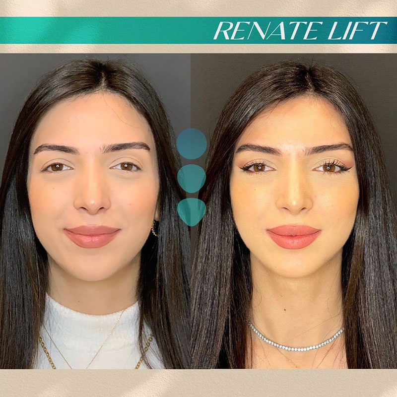 Renate Clinic - BEFORE/AFTER