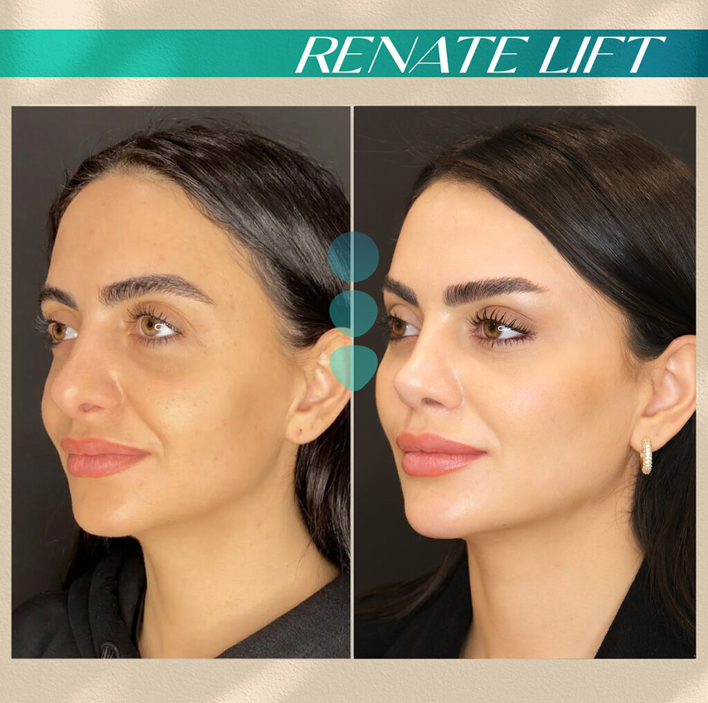 BEFORE/AFTER - Renate Clinic