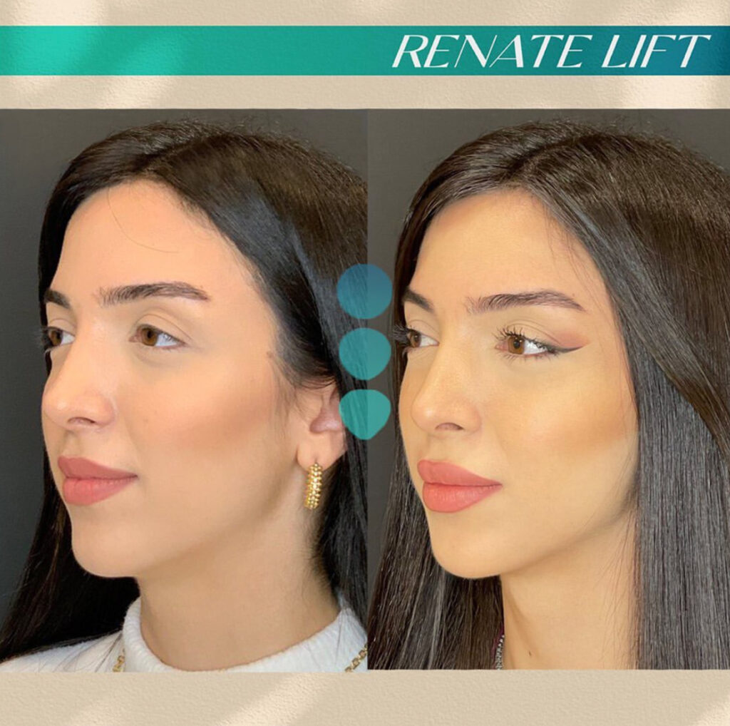 BEFORE/AFTER - Renate Clinic