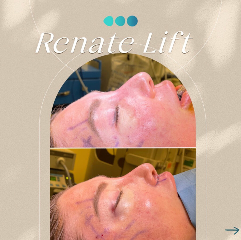 BEFORE/AFTER - Renate Clinic