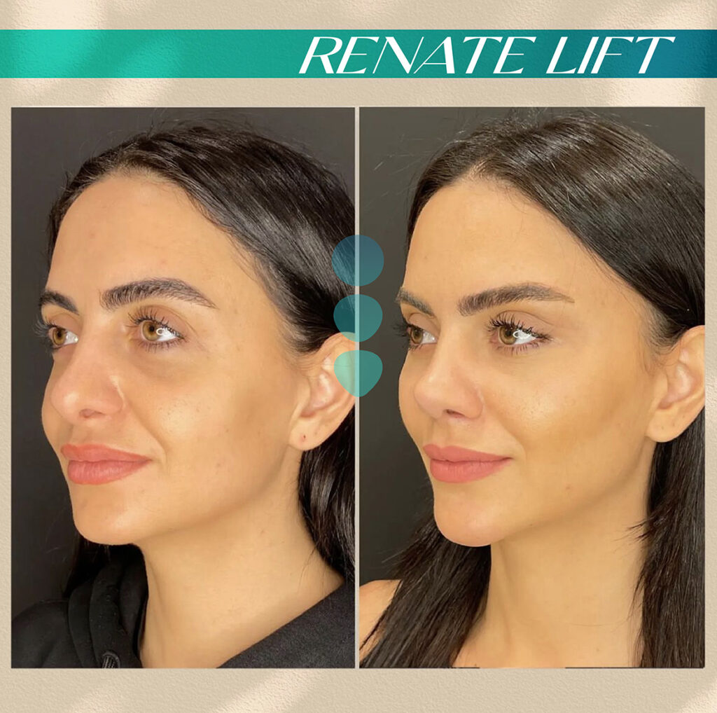 BEFORE/AFTER - Renate Clinic